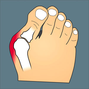 Fisioterapia tras una cirugía en el pie - Fisiohogar